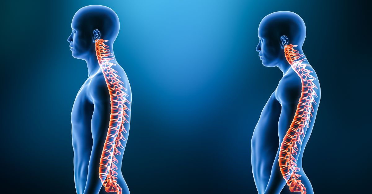 Wady postawy u dzieci | Rodzaje, przyczyny, leczenie