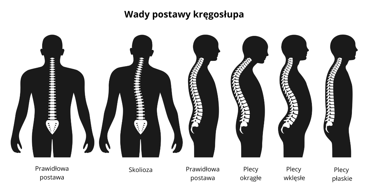 Wady postawy u dzieci | Rodzaje, przyczyny, leczenie